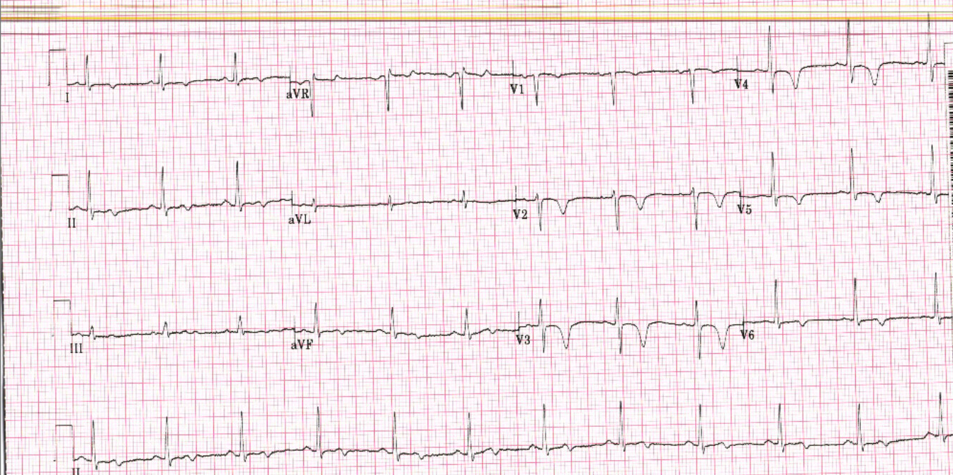 EKG answer | Searcy EM