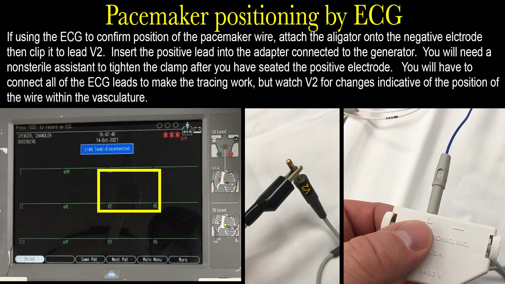 Transvenous Pacemaker | Searcy EM