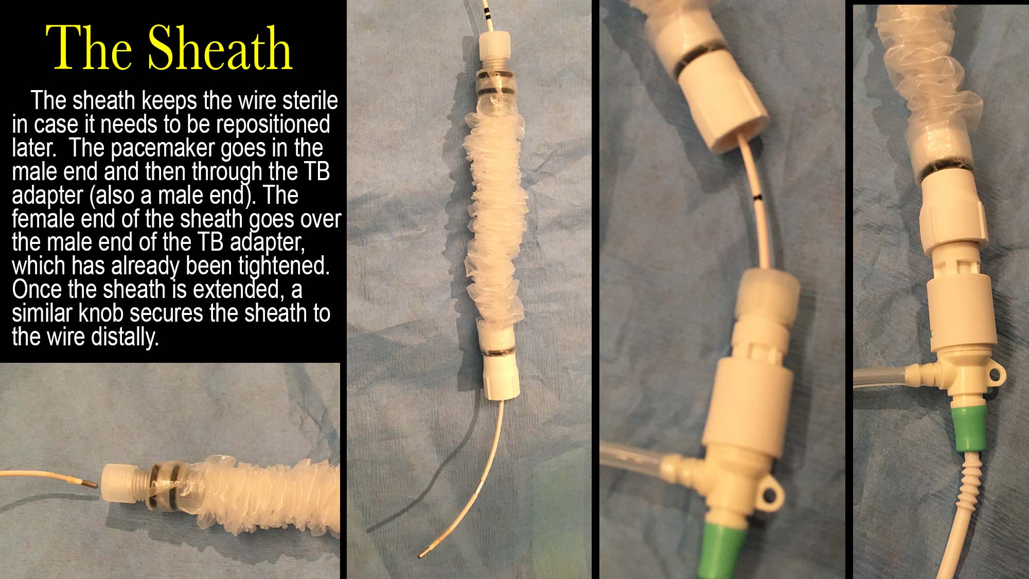 Transvenous Pacemaker | Searcy EM