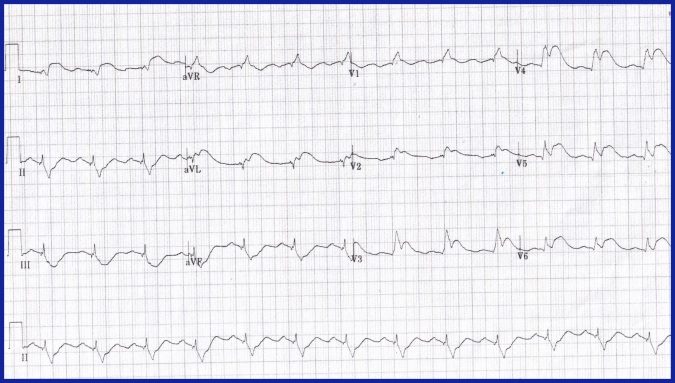 Regional Wall Motion Abnormality | Searcy EM