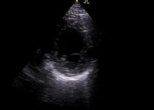 Regional Wall Motion Abnormality | Searcy EM