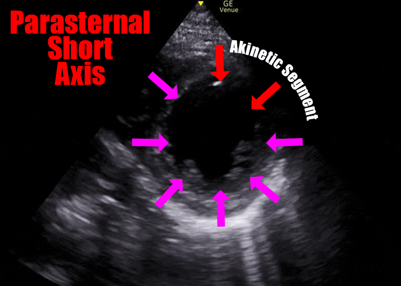 Regional Wall Motion Abnormality | Searcy EM