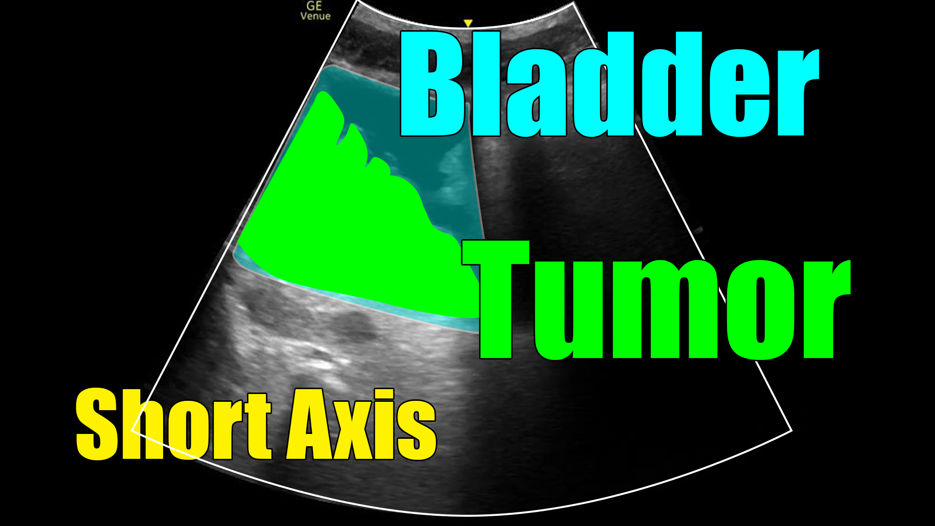 Bladder Ultrasound: part 2 | Searcy EM