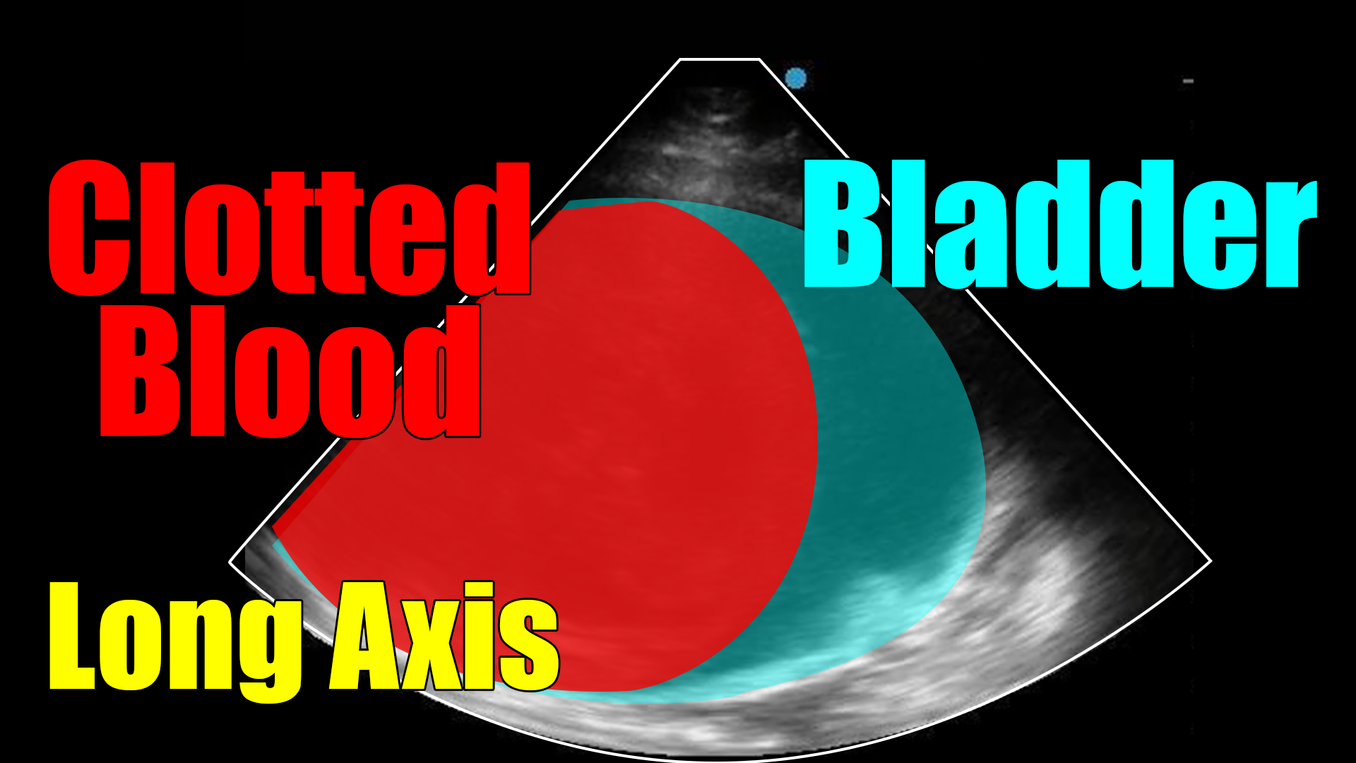 Bladder Ultrasound: part 2 | Searcy EM