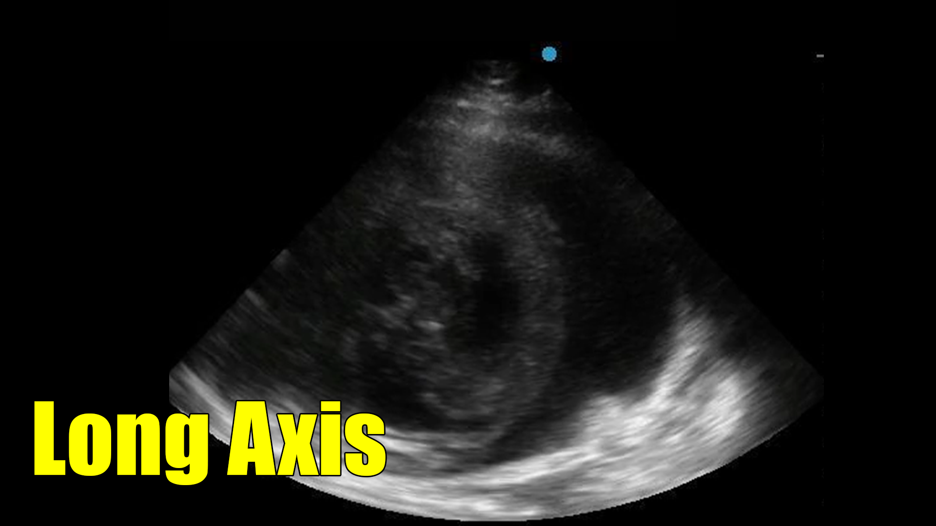 Bladder Ultrasound: part 2 | Searcy EM
