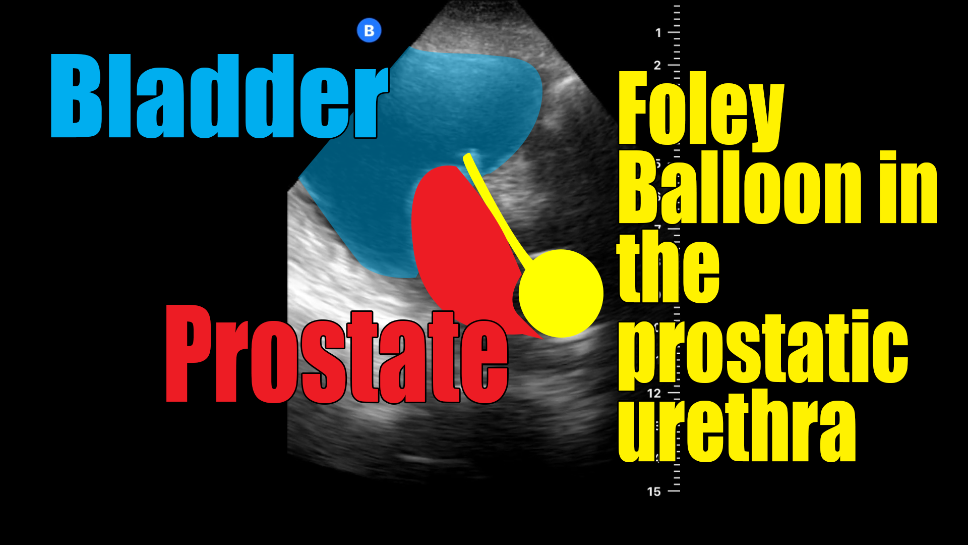 Bladder Ultrasound: part 1 | Searcy EM