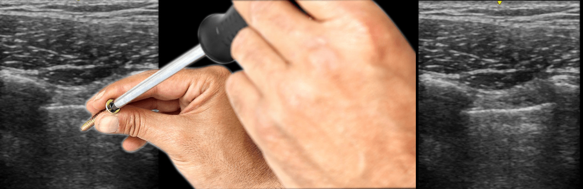 Tighten the screws on your lung ultrasound | Searcy EM