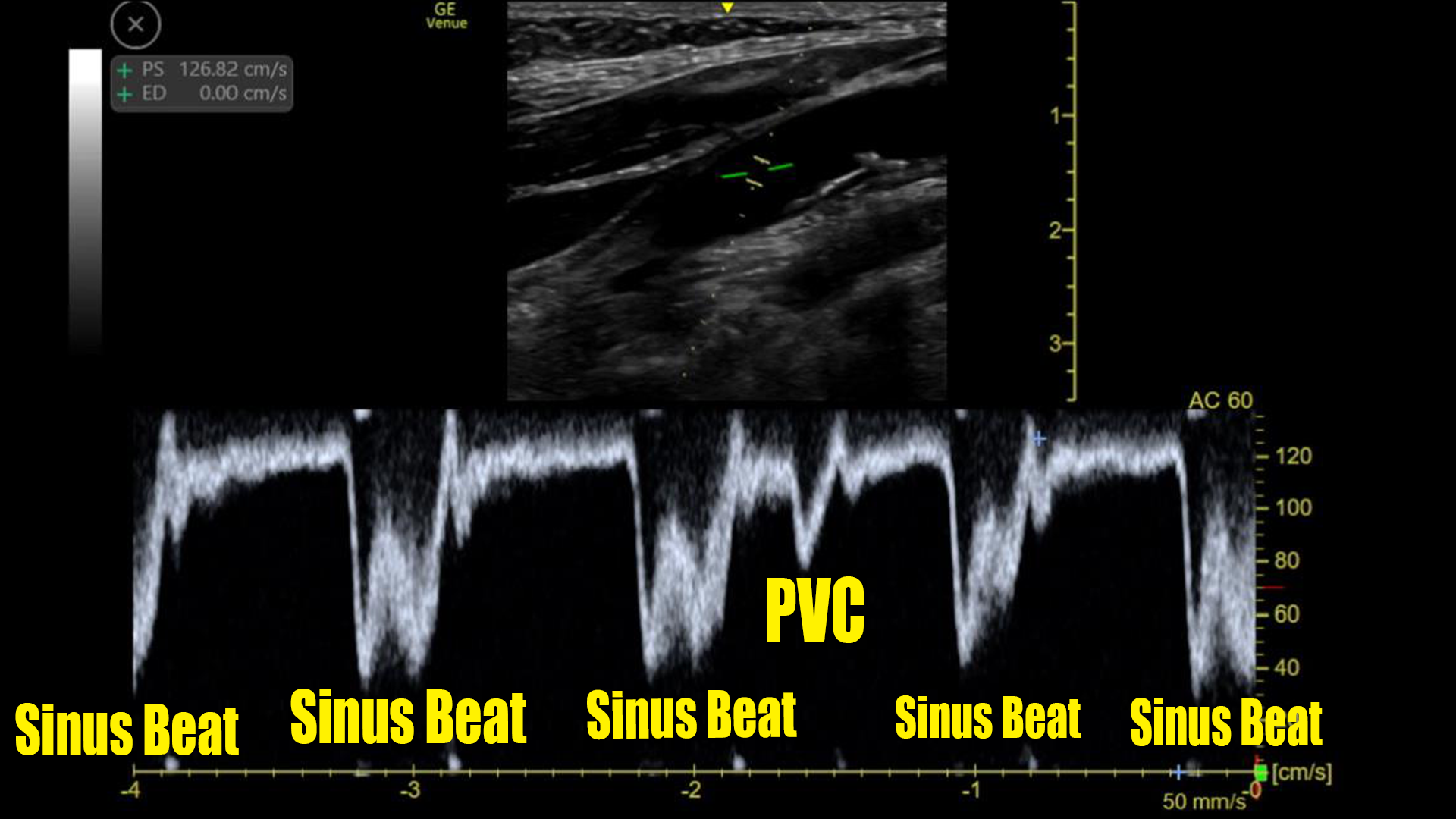 What’s the heart rate: follow up | Searcy EM
