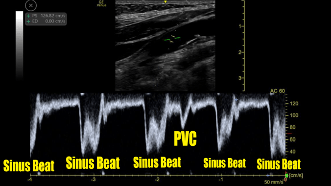 What’s the heart rate: follow up | Searcy EM
