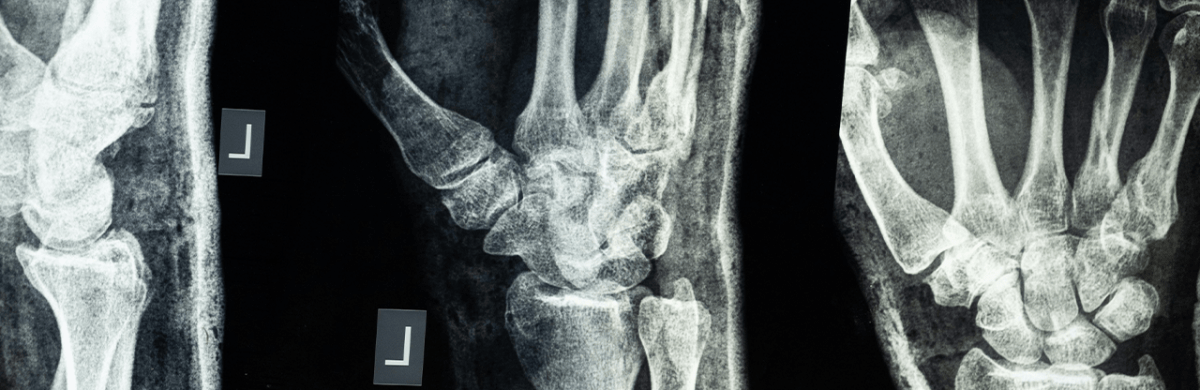 X-rays or Ultrasounds for fractures? | Searcy EM