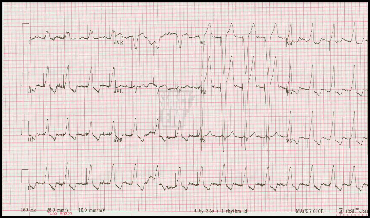 Paced EKGs | Searcy EM