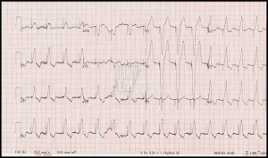 Paced EKGs | Searcy EM