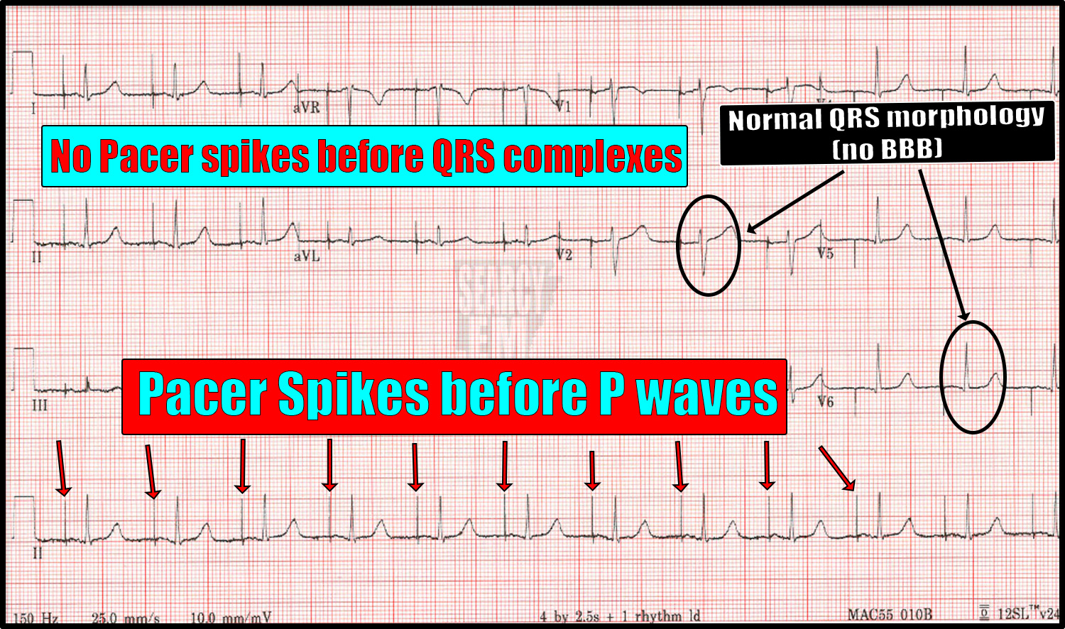 Paced EKGs | Searcy EM