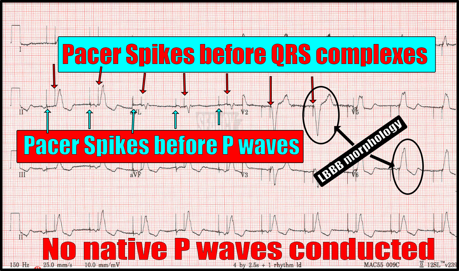 Paced EKGs | Searcy EM