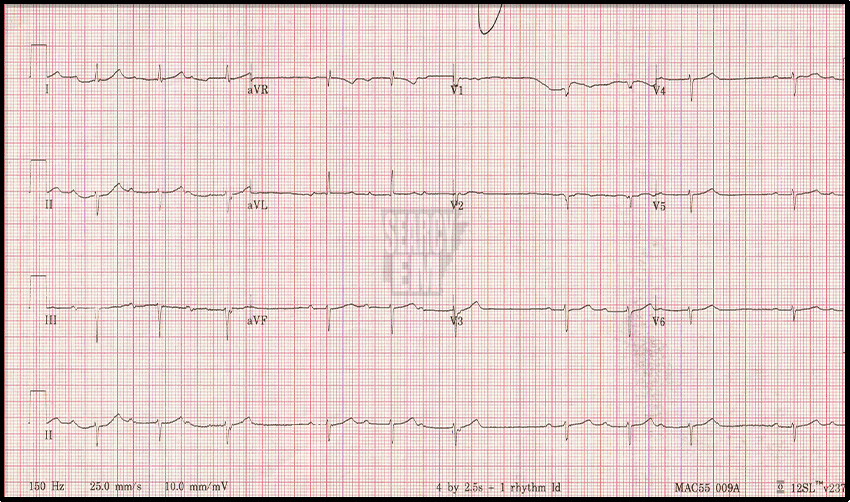 An atypical day of EKG’s | Searcy EM