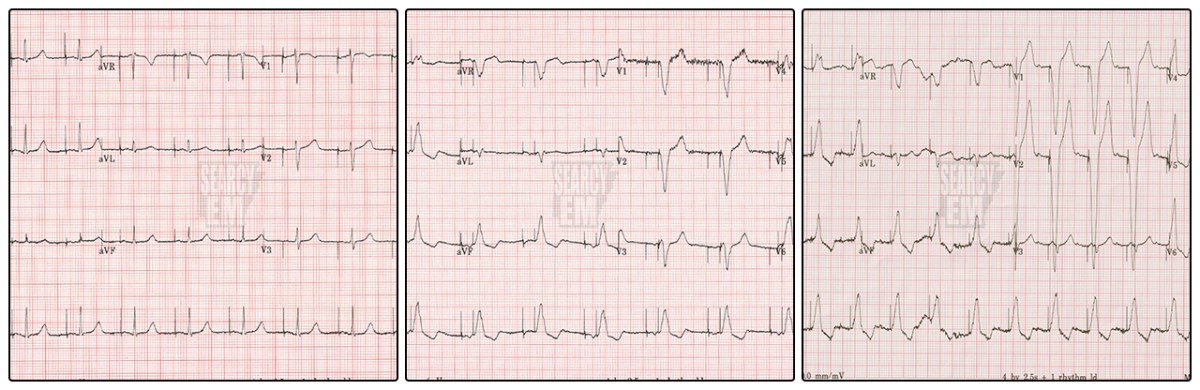Paced EKGs | Searcy EM