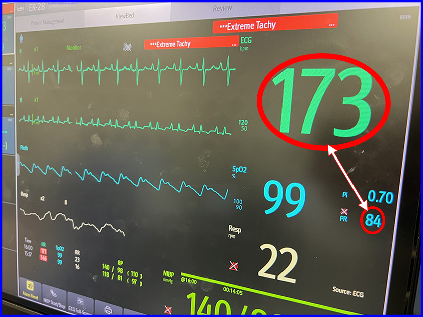 Cardiac monitored fooled again… | Searcy EM